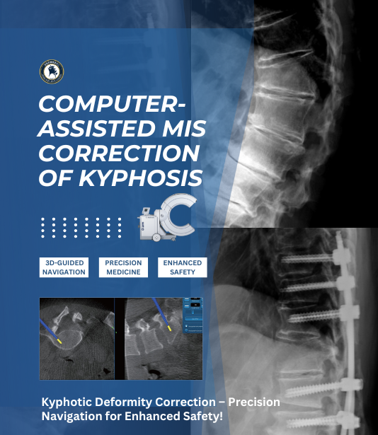 3D Computer-Assisted Kyphosis Correction Surgery | Safe & Precise ...
