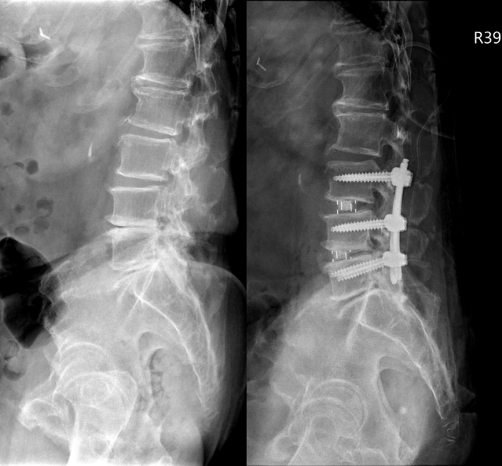 OLIF Surgery – A Safe Option for Lumbar Stenosis in the Elderly-微創脊椎關節 ...