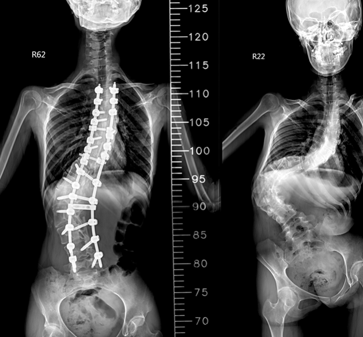 Scoliosis Correction—Single-Stage Correction of Severe 126-Degree ...