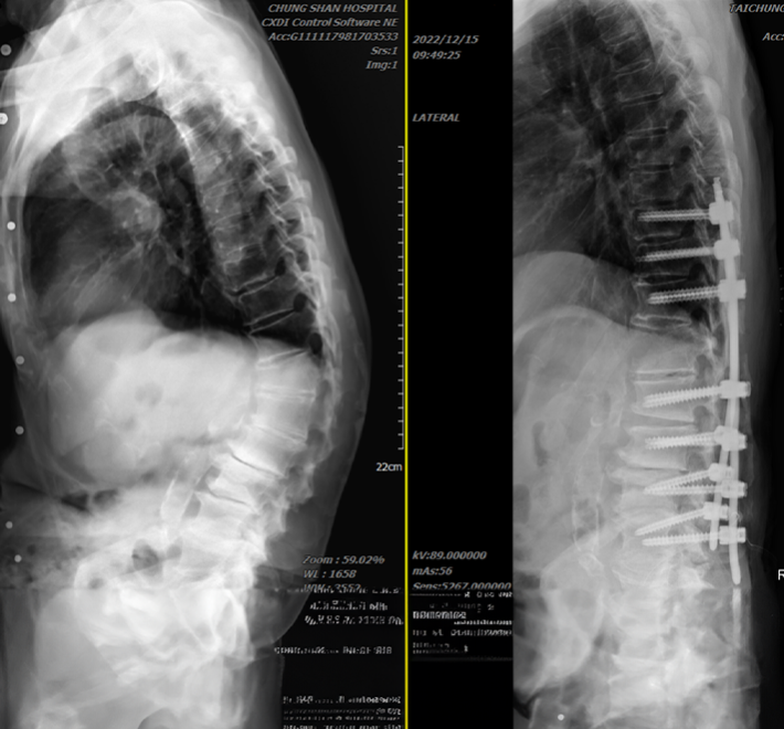 Kyphotic Deformity Correction—From 54° to 8° for an 83-Year-Old Patient ...