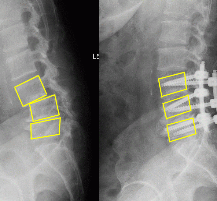 Spine Fusion Surgery – Addressing Lumbar Spondylolisthesis and Disc ...