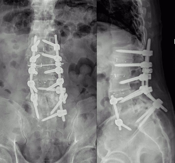 Spine Revision Surgery – Recurring Back Pain and Leg Numbness After ...
