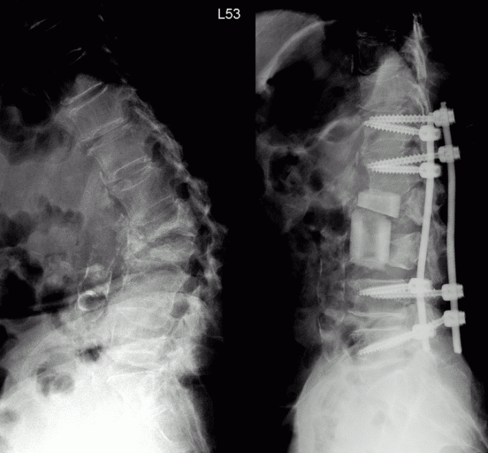 Minimally Invasive Kyphotic Deformity Correction—Precision Navigation ...