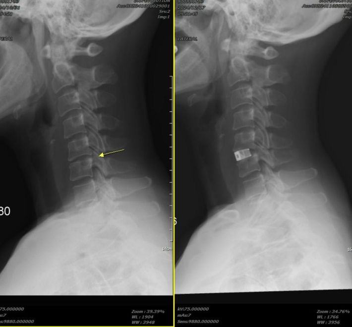 Cervical Spine Surgery – Chronic Pain Due to Cervical Disc Herniation-微 ...