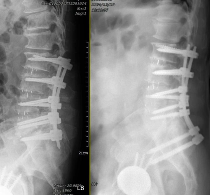 Spine Revision Surgery – Postoperative Spinal Infection and Instability ...