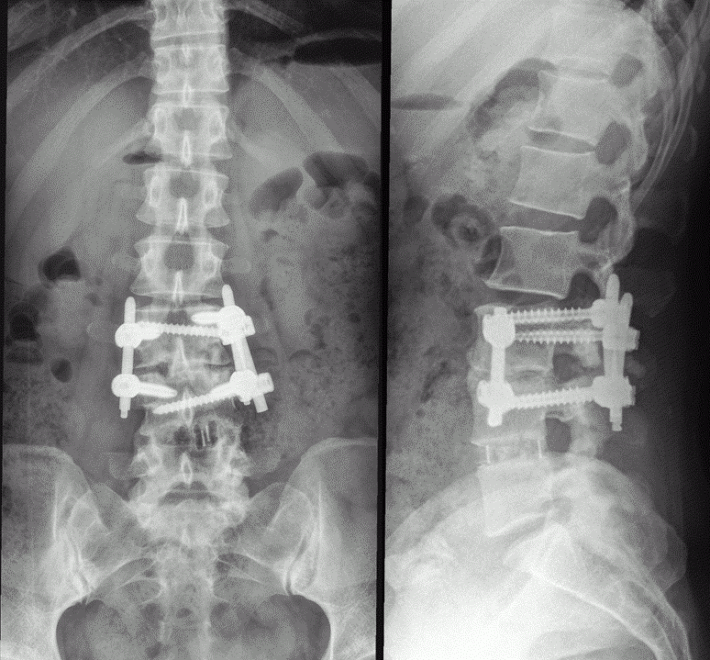 Spine Revision Surgery – Spine Instability Due Nonunion-微創脊椎關節中心 | Dr ...