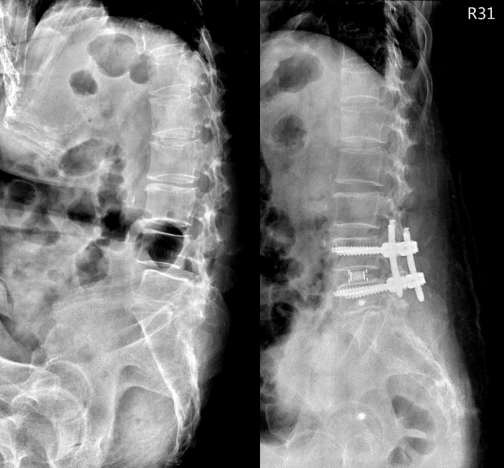 OLIF Surgery – A Reliable Solution for Spondylolisthesis-微創脊椎關節中心 | Dr ...