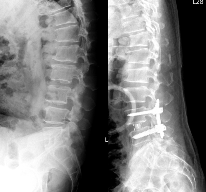 OLIF Surgery – A Procedure Suitable for Heavy Laborers-微創脊椎關節中心 | Dr ...