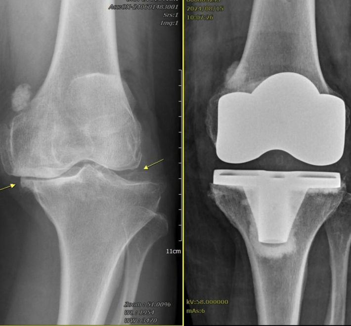 Minimally Invasive Total Knee Replacement—Severe Knee Degeneration in ...