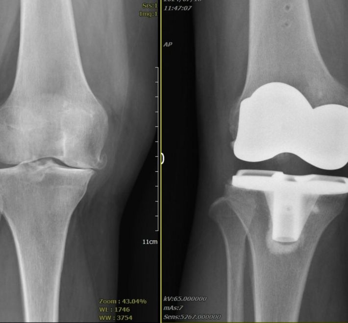 Minimally Invasive Total Knee Replacement—Robotic-Assisted Surgery for ...