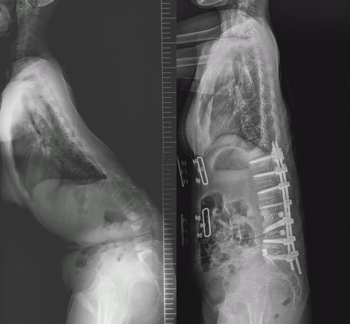 Minimally Invasive Kyphotic Deformity Correction – Complete Inability ...