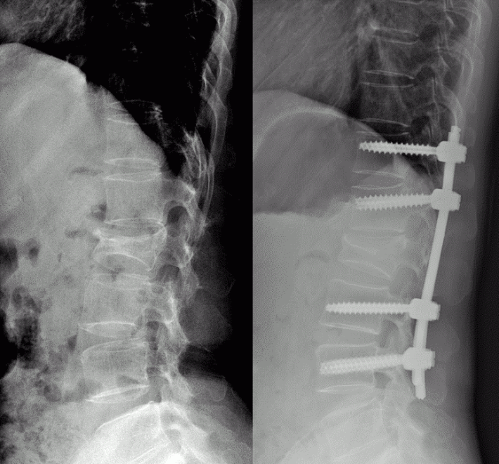 Spine fracture—Navigation-Assisted Spine Surgery Eases Pain from ...