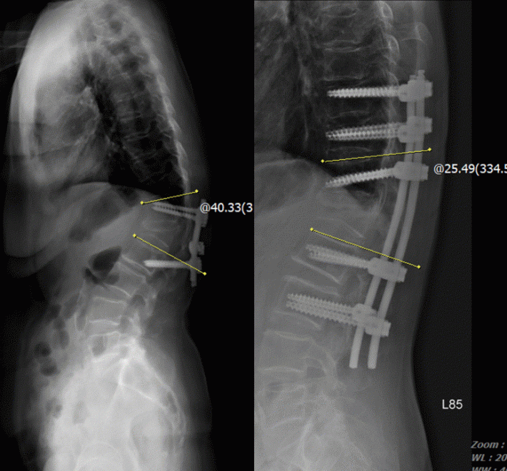 Minimally Invasive Kyphotic Deformity Correction—Stiff Kyphosis Due to ...