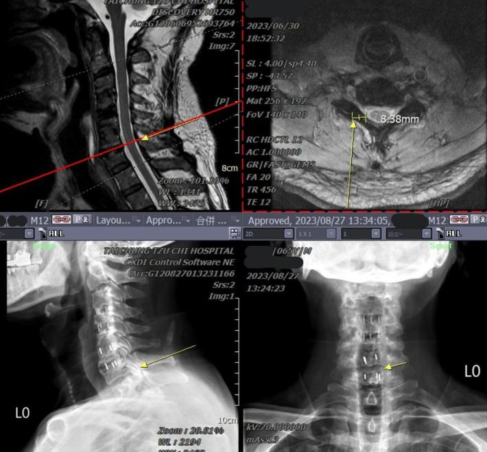 Endoscopic Spine Surgery—Revision Cervical Spine Surgery-微創脊椎關節中心 | Dr ...