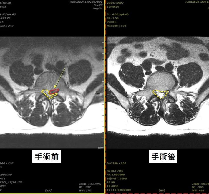 Endoscopic Spine Surgery—Herniated Disc from Prolonged Heavy Lifting-微創 ...