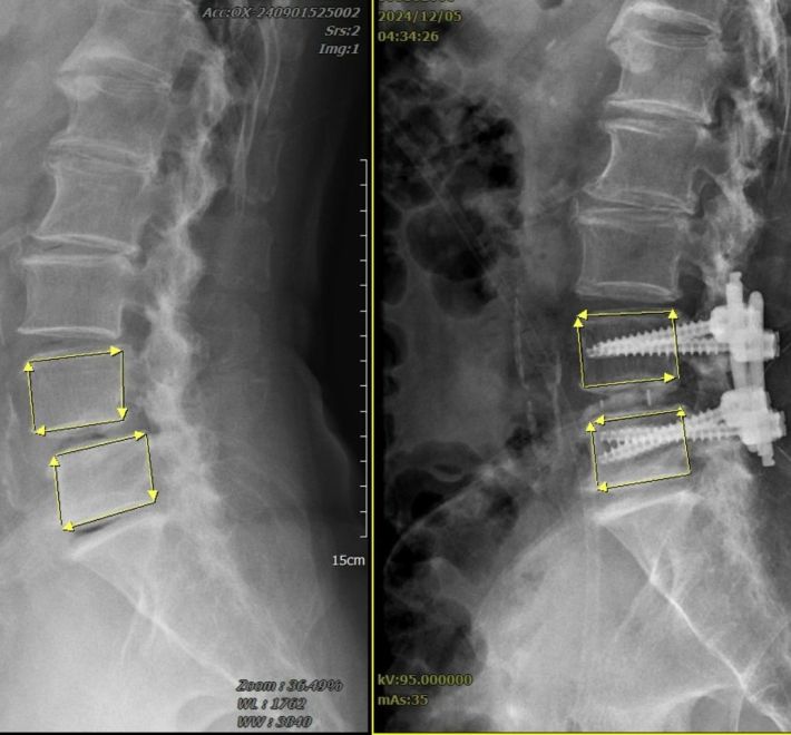 Spine Fusion Surgery – Relieving Back Pain and Leg Numbness from ...