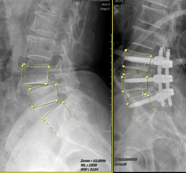 Spine Fusion Surgery – Relief from Spondylolisthesis and Spinal ...