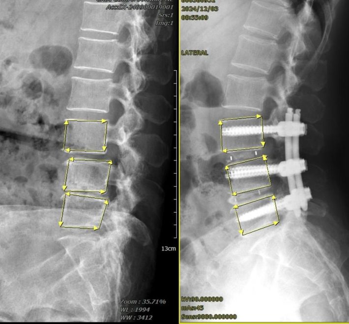 Spine Fusion Surgery – A Savior for Degenerative Disc Disease-微創脊椎關節中心 ...