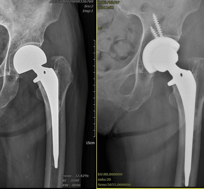 Total Hip Replacement Surgery—Hip Revision Surgery for Elderly Patient ...